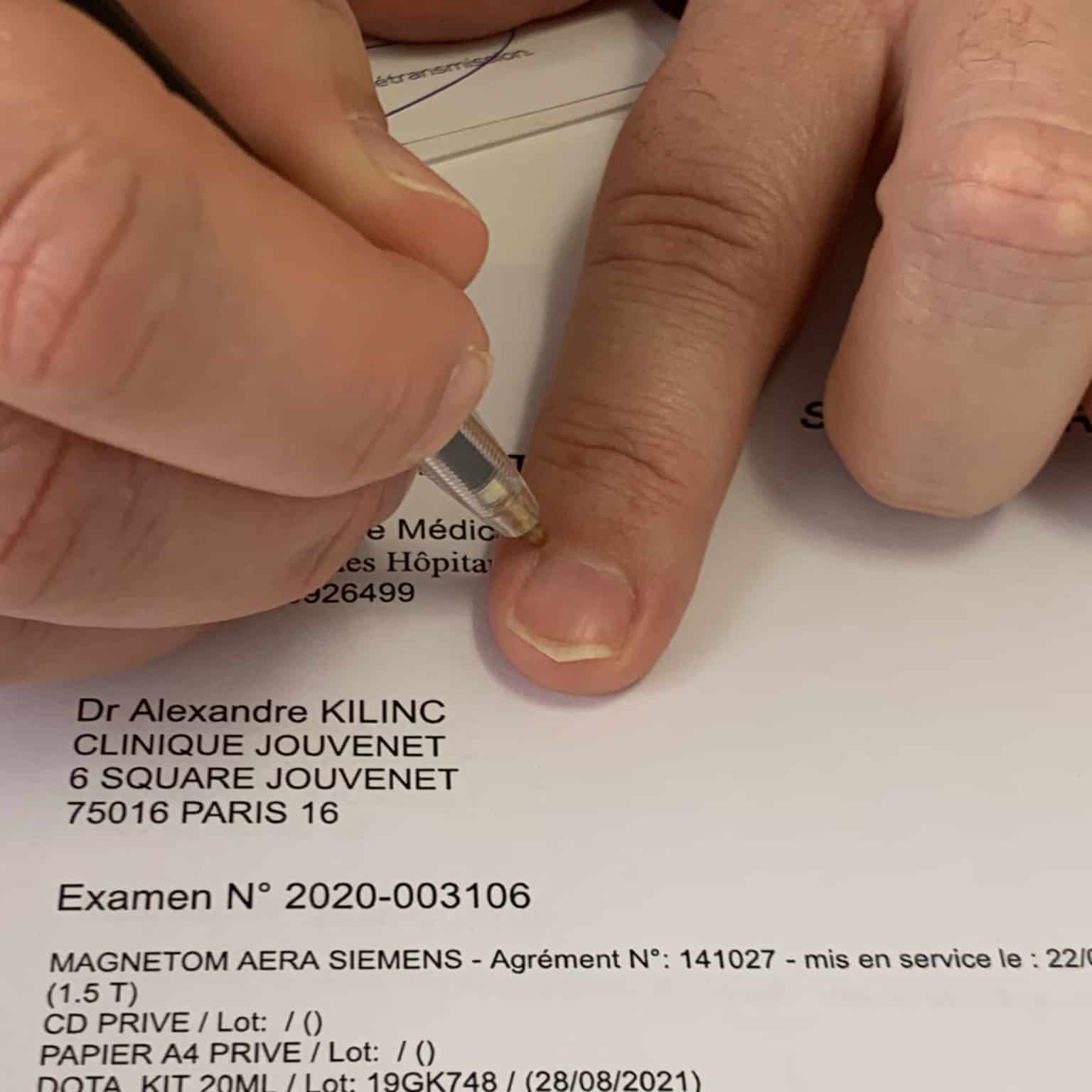 Tumeur Glomique Doigt | Dr Kilinc - Chirurgien Paris