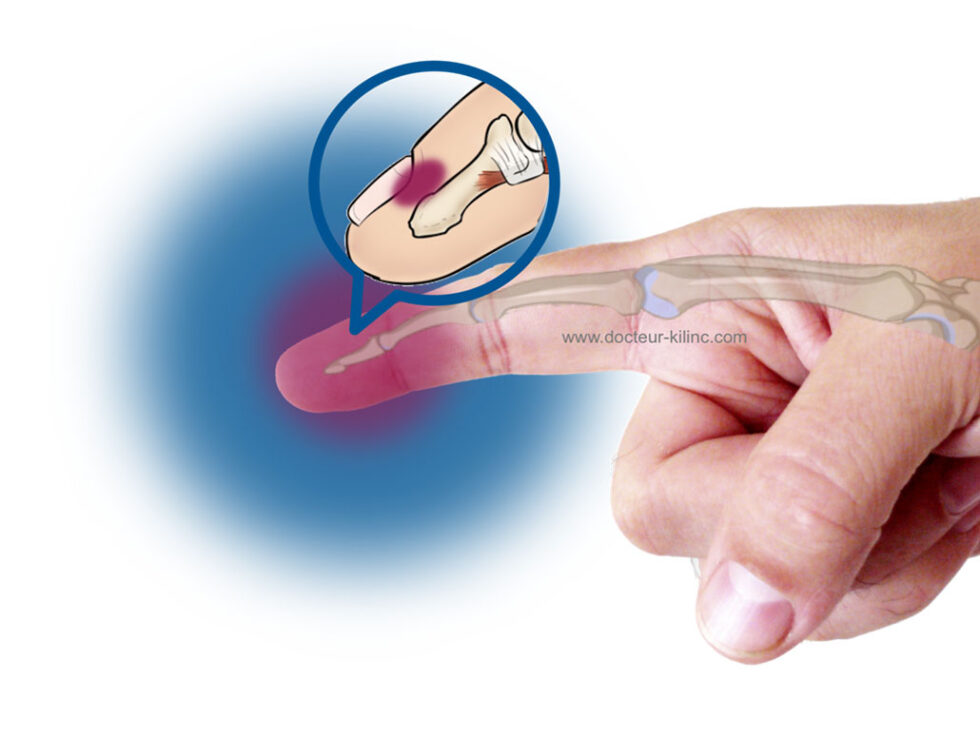 Chirurgie de la main à Paris | Dr Kilinc