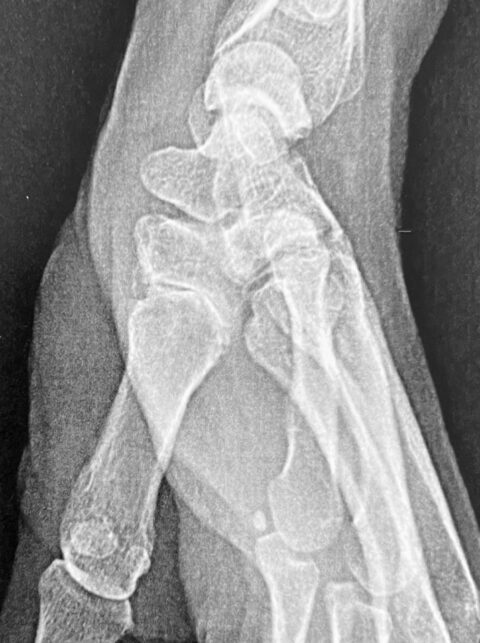 Rhizarthrose du pouce | Dr Kilinc - Chirurgien à Paris