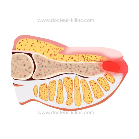 Tumeur glomique doigt symptôme, cause, traitement chirurgie main