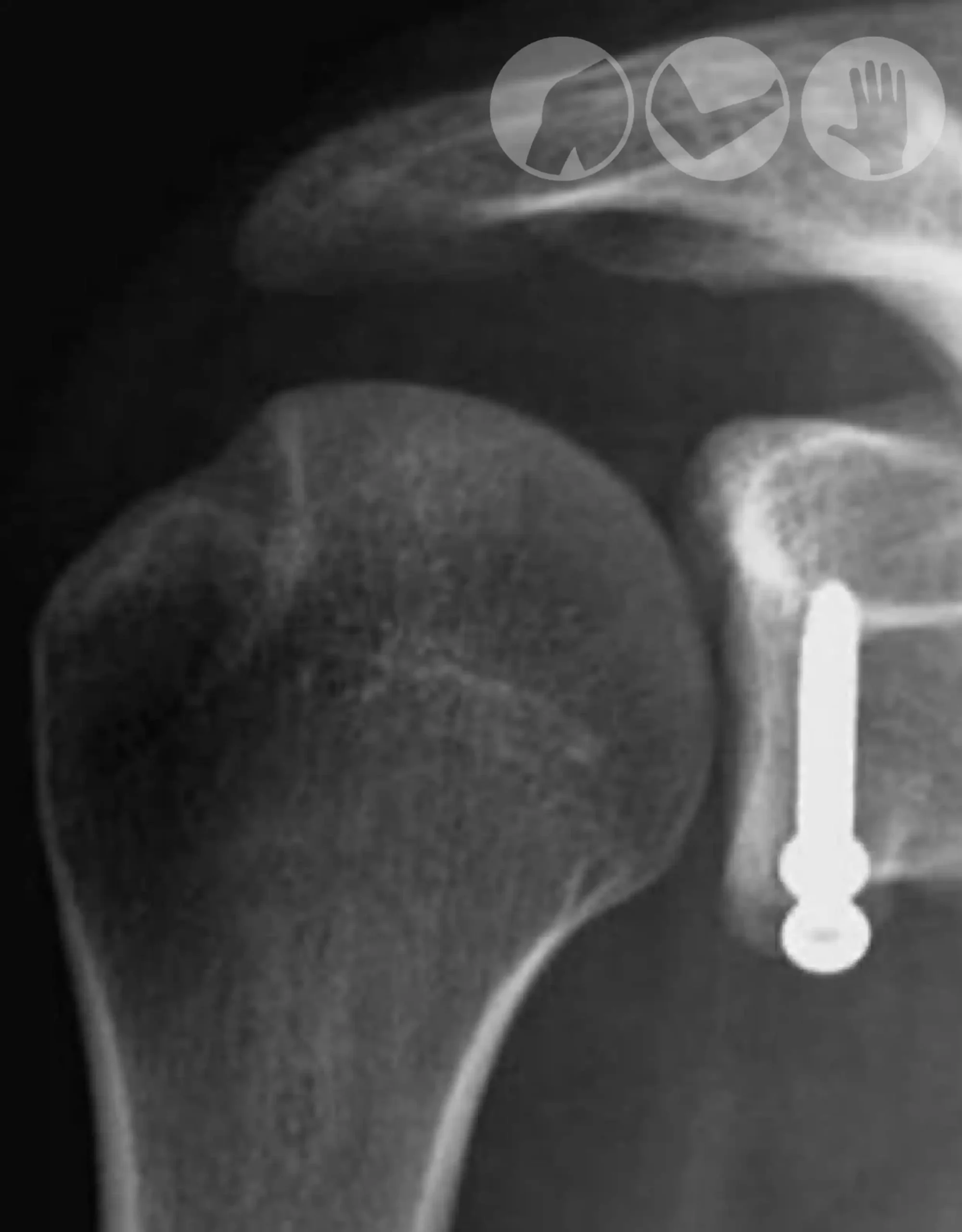 L'intervention de Latarjet pour traiter l'instabilité de l'épaule